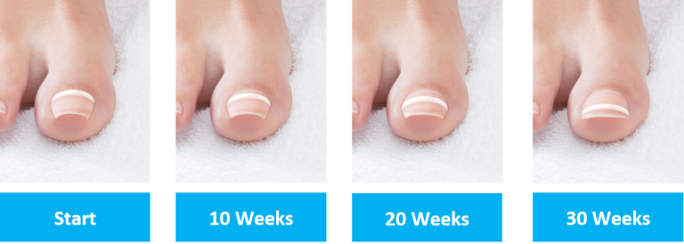 Onyfix – Joanne McParland Podiatry